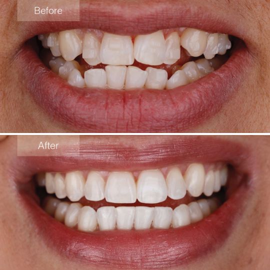 Invisalign / Invisible Aligners - Artista Advanced Dentistry