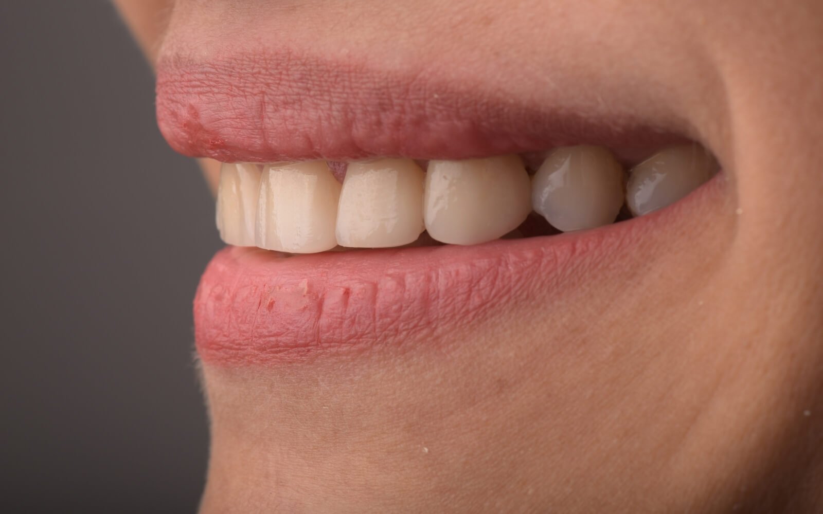 Smile Designing with Veneers - Artista Advanced Dentistry